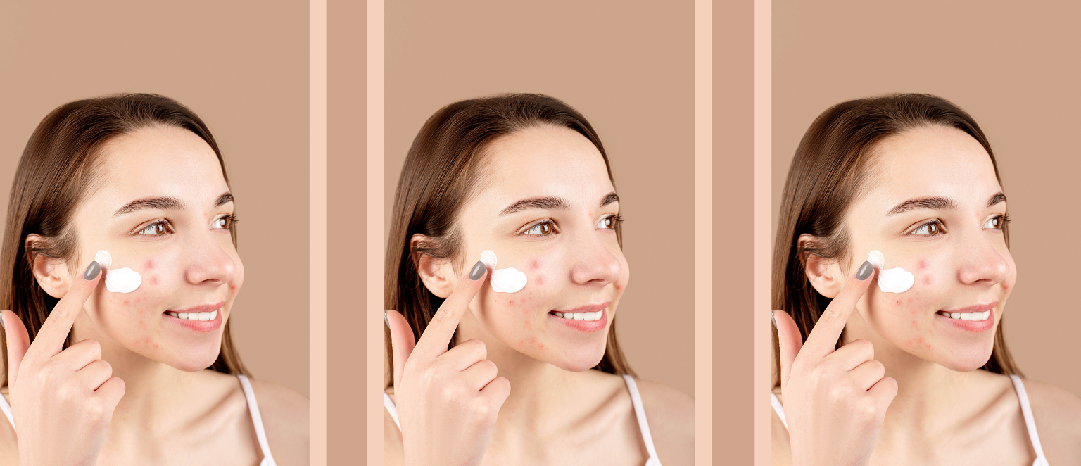 How Salicylic acid can come to the rescue for breakout-prone skin - Get ...