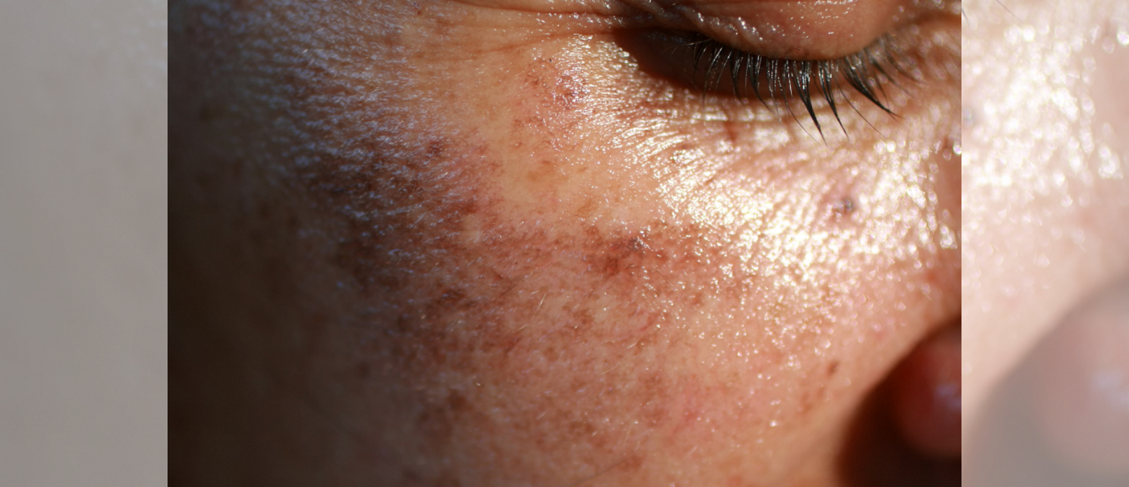 How to heal skin pigmentation holistically - Get It Magazine